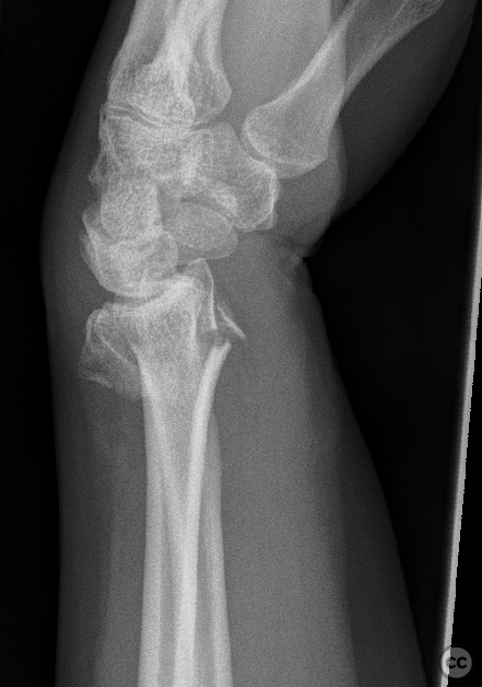 Reduction of the radial column preserving Brachioradialis using a ...