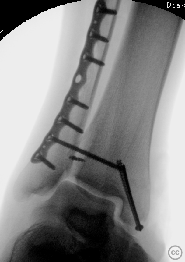 Pronation Abduction (PAb) Weber C / Herscovici B bimalleolar ankle fracture