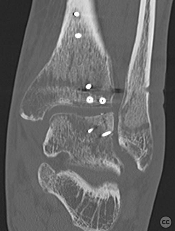 Anterior fracture dislocation with impression fracture of the articular ...