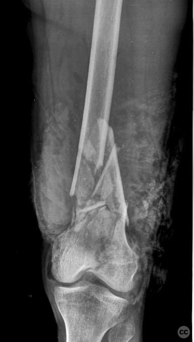 Double plate fixation of a comminuted supra- and intercondylar distal ...