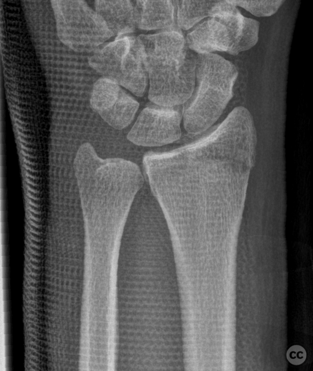 Operative Management of Chauffeur's Fracture with Intraarticular ...
