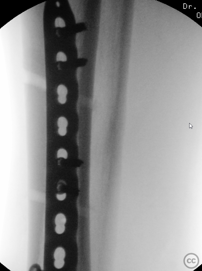 Combined distal 1/3 tibia fracture with SAD bimalleolar ankle fracture