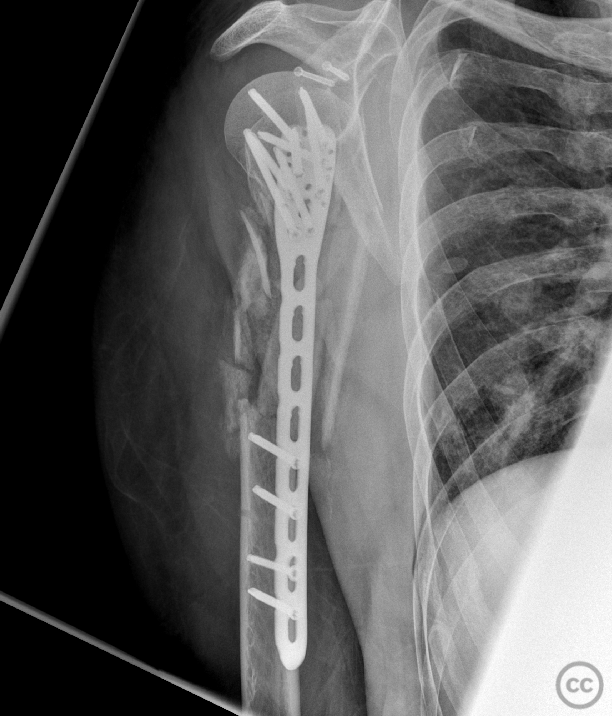 Multifragmentary Proximal Humerus Fracture with Scapula Fracture in a ...