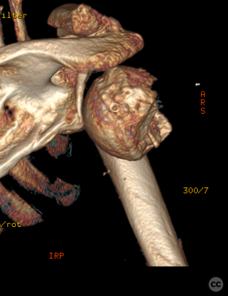 Displaced surgical neck of humerus fracture with brachial plexus ...