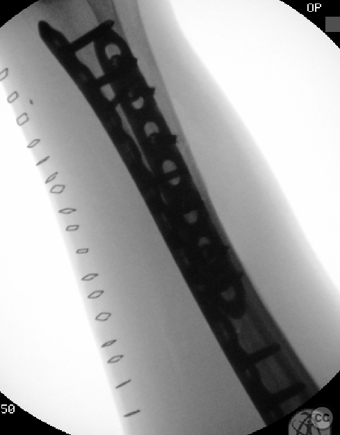 Henry's approach to a segmental radial shaft fracture