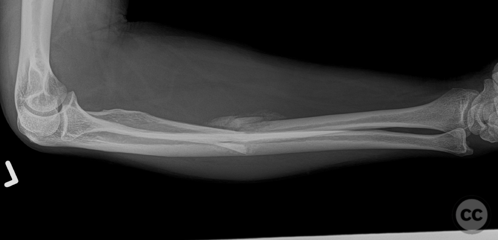Revision Osteosynthesis for Malunited Midshaft Radius Fracture