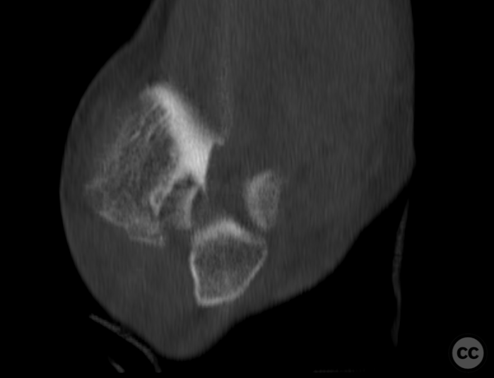 C3 articular humerus fracture with ulnar column vertical shear injury
