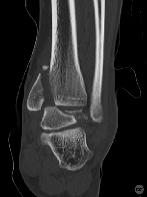 Anterior fracture dislocation with impression fracture of the articular ...