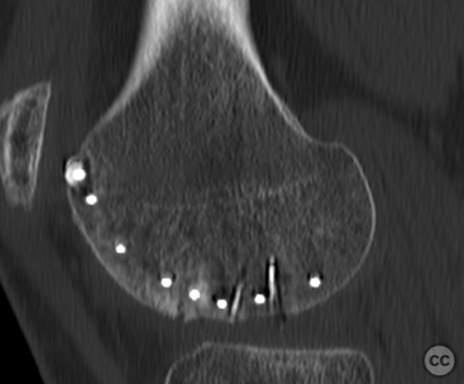 Destructive osteochondral fracture of the lateral femoral condyle ...