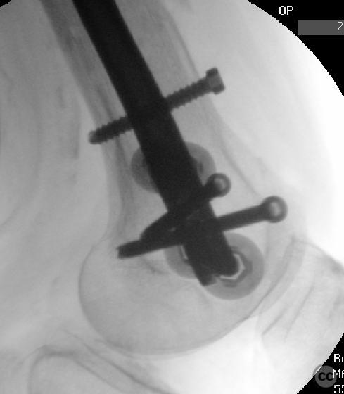 Retrograde SCN plus Poller screw for a distal 1/3 femoral diaphyseal ...