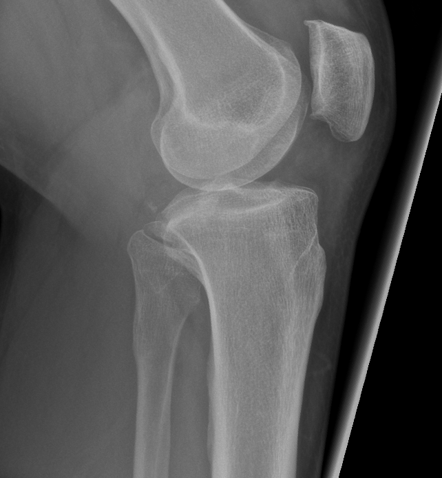 Posterolateral rim-plate Schatzker 2 tibial plateau