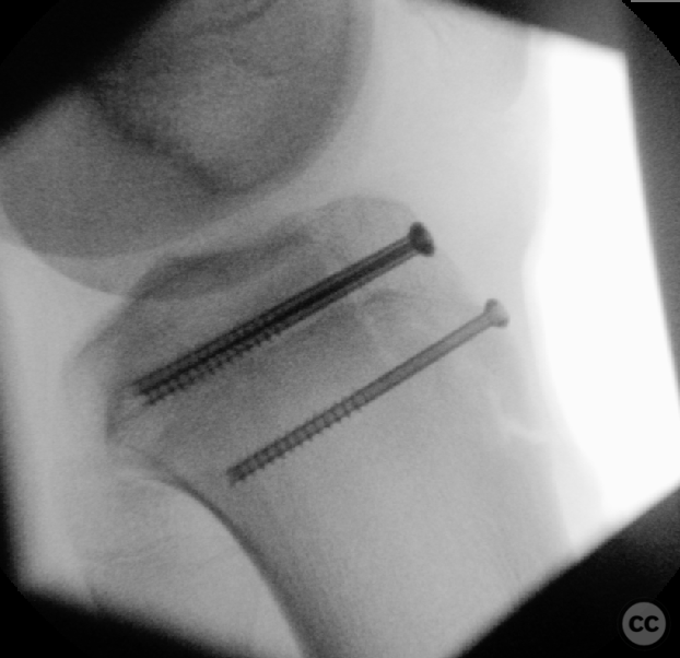 Tibial tubercle fracture - Type III