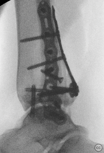 Mason and Molloy 2B Posterior Malleolar Fracture. Anterior collicular ...