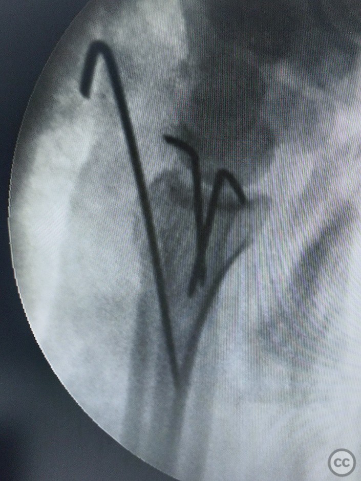Percutaneous k-wire fixation of an intraarticular distal radius fracture