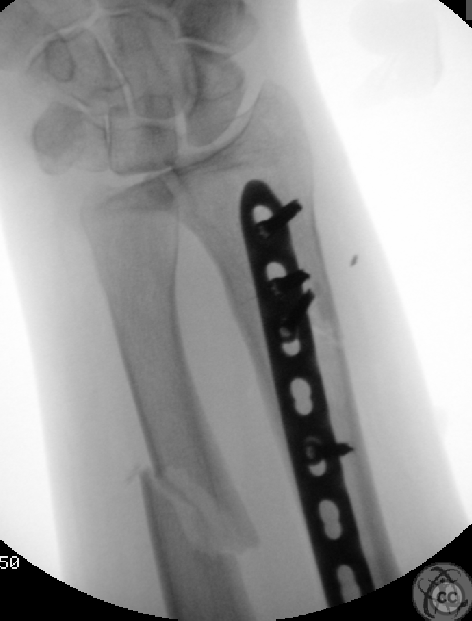 Henry's approach to a segmental radial shaft fracture