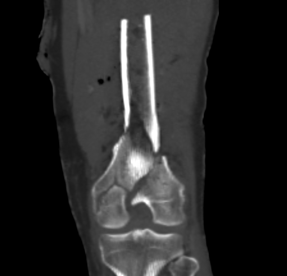 Segmental Femur with intercondylar separation