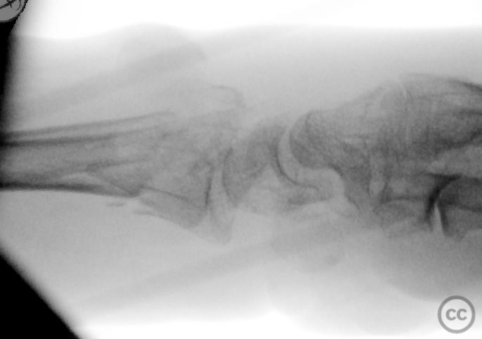 Radiocarpal distraction reduction technique for distal radius fracture
