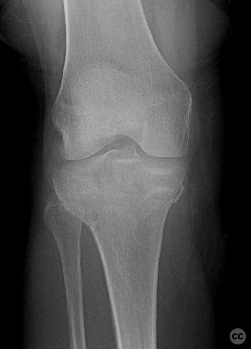 Varus hyperextension tibial plateau fracture