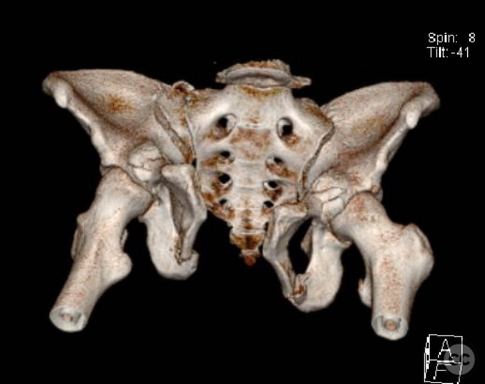 Complex Bilateral Pelvic Ring Injury with APC2 and APC3 Patterns