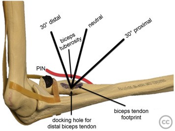 Distal biceps bicortical endobutton fixation