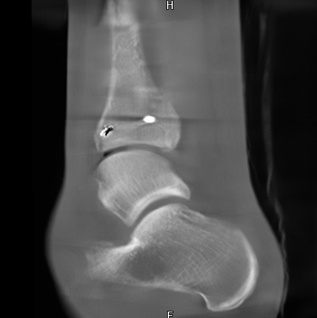 Chaput tubercle syndesmosis avulsion Weber C bilmalleolar ankle fracture