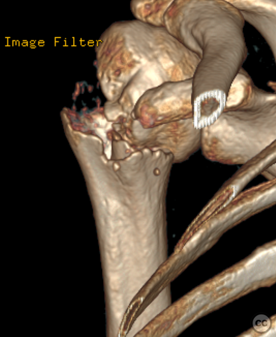 Subacute 2 part proximal humerus fracture