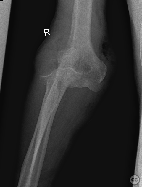 Open posterolateral elbow dislocation with displaced radial neck fracture
