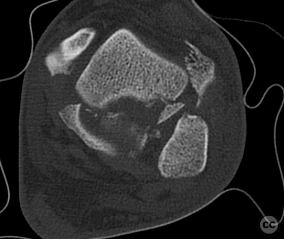 Anterior fracture dislocation with impression fracture of the articular ...