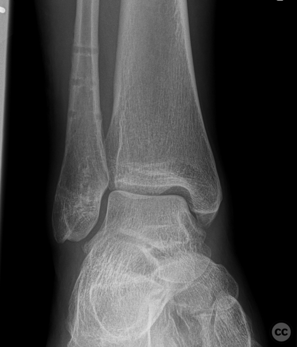 Exploration and Neurolysis for Persistent Neuropathic Pain Post-Weber B ...