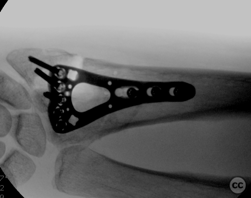 Complex comminuted and impacted distal radius fracture