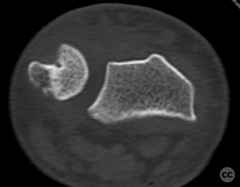 Revision of Galeazzi Fracture Dislocation with TFCC Repair and Ulnar ...
