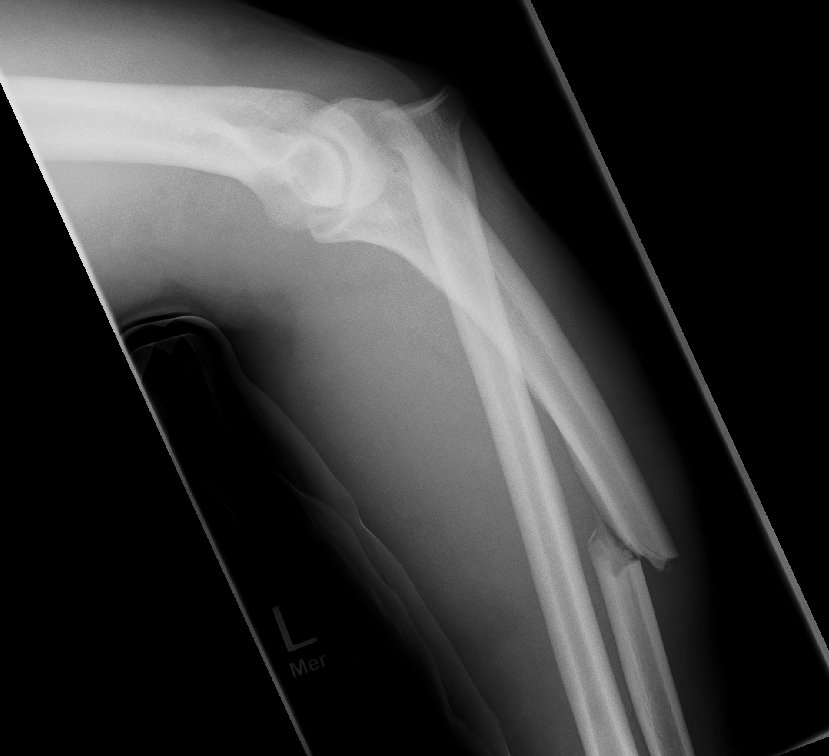 Essex-Lopresti fracture-dislocation