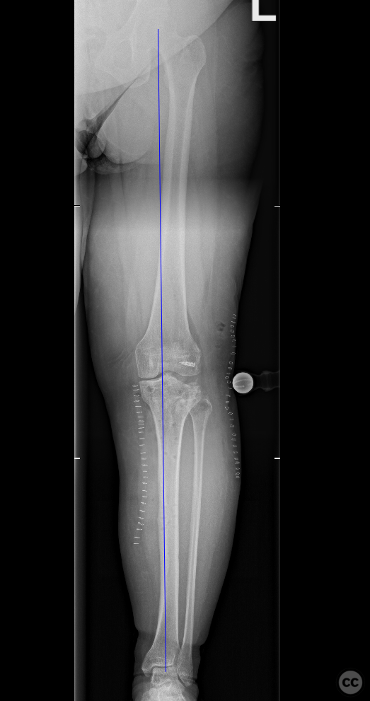 Schatzker 6 tibial plateau with lateral femoral epicondyle osteotomy