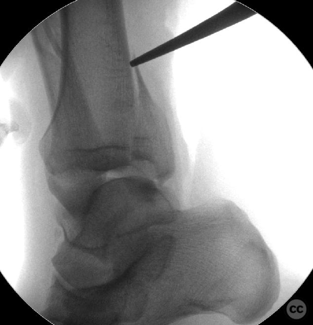 Mason III posterior malleolus fracture dislocation