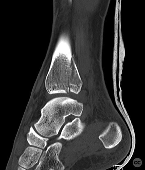 Mason III posterior malleolus fracture dislocation