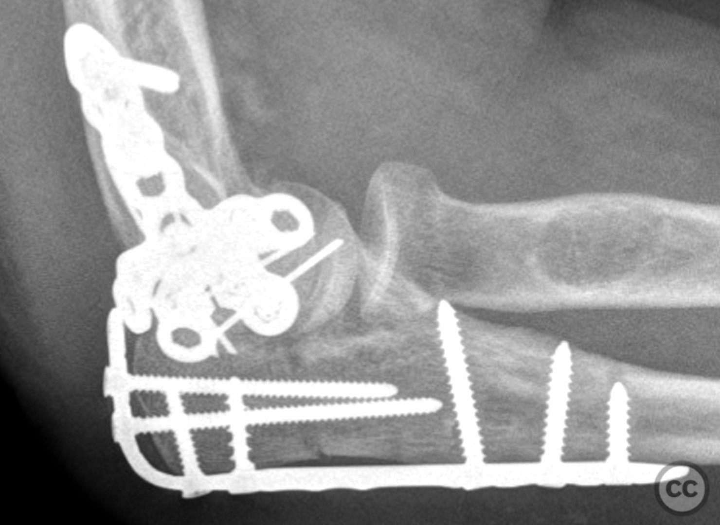 Dubberly 2B articular humerus fracture - skinny wire and radial plate ...