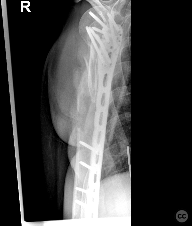 Multifragmentary Proximal Humerus Fracture with Scapula Fracture in a ...