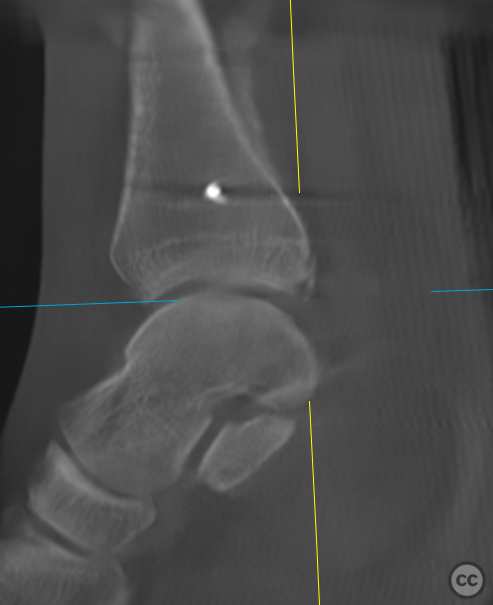 SER ankle injury with occult PITFL + deltoid instability