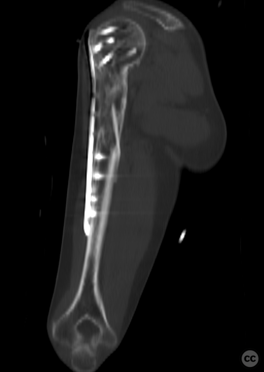 Multifragmentary Proximal Humerus Fracture with Scapula Fracture in a ...