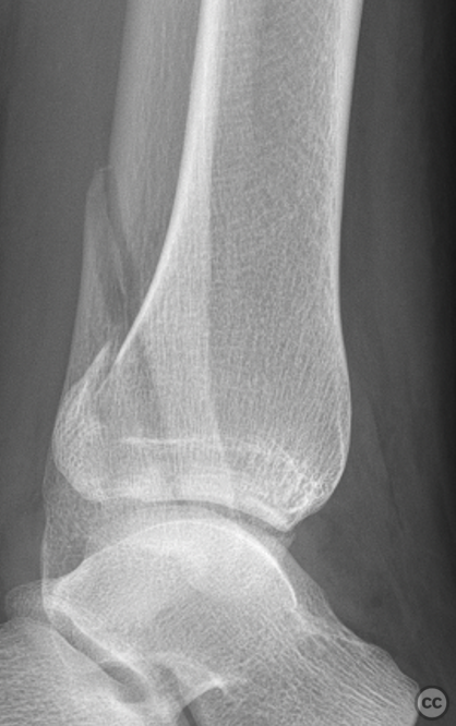 Mason and Molloy 2B Posterior Malleolar Fracture with Posteromedial die ...