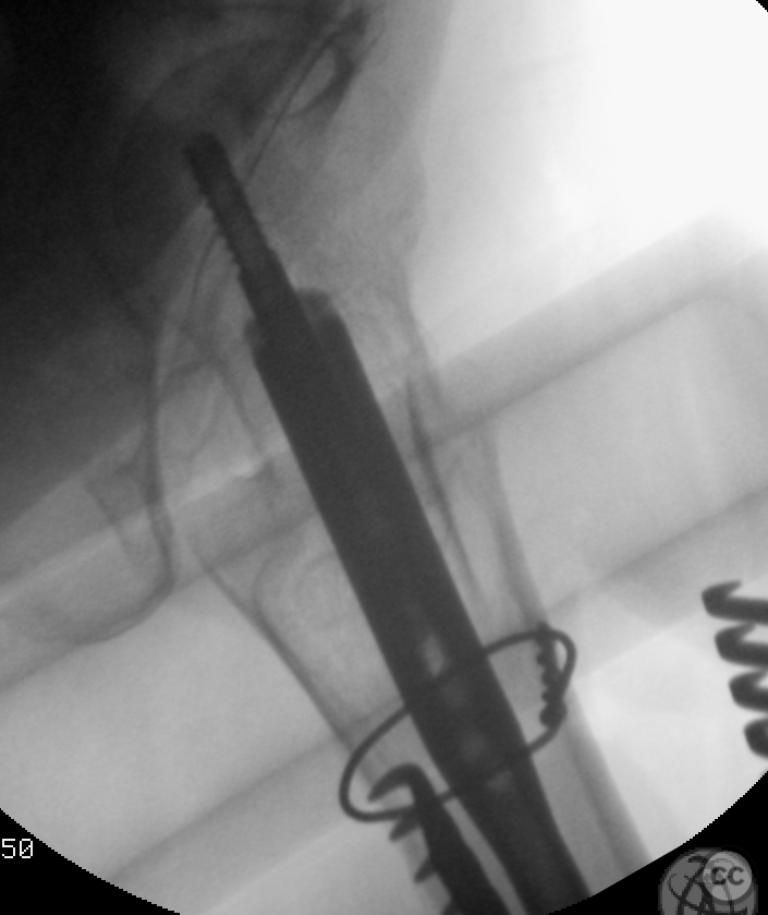 Multifragment intertrochanteric femur fracture with subtrochanteric ...