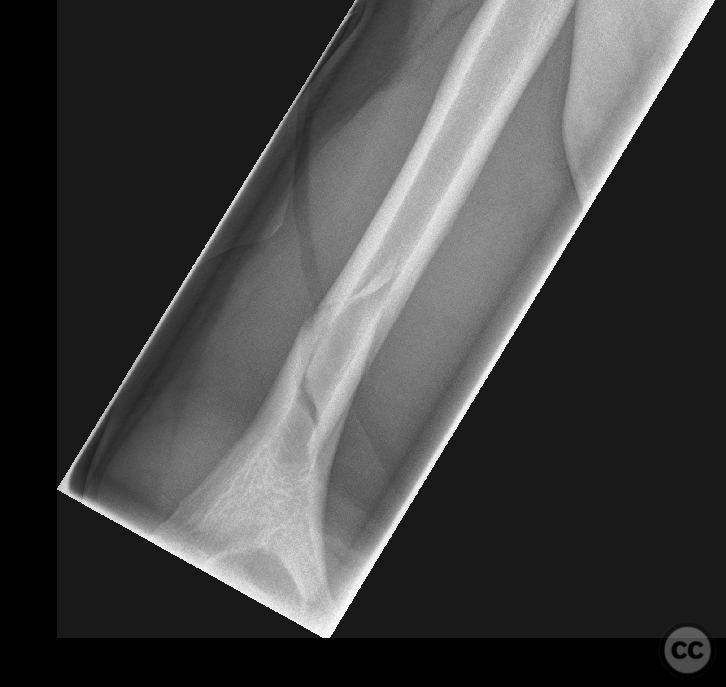 Distal 1/3 humerus shaft fracture - a lateral paratricipital approach ...