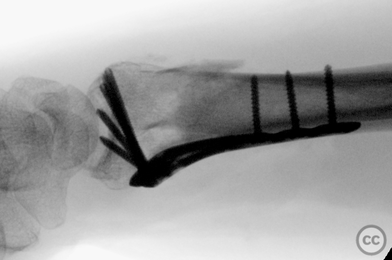 Complex comminuted and impacted distal radius fracture