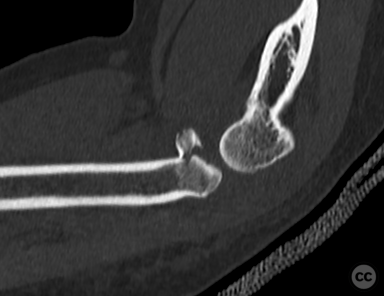 Mason III radial head fracture - Boyd's approach