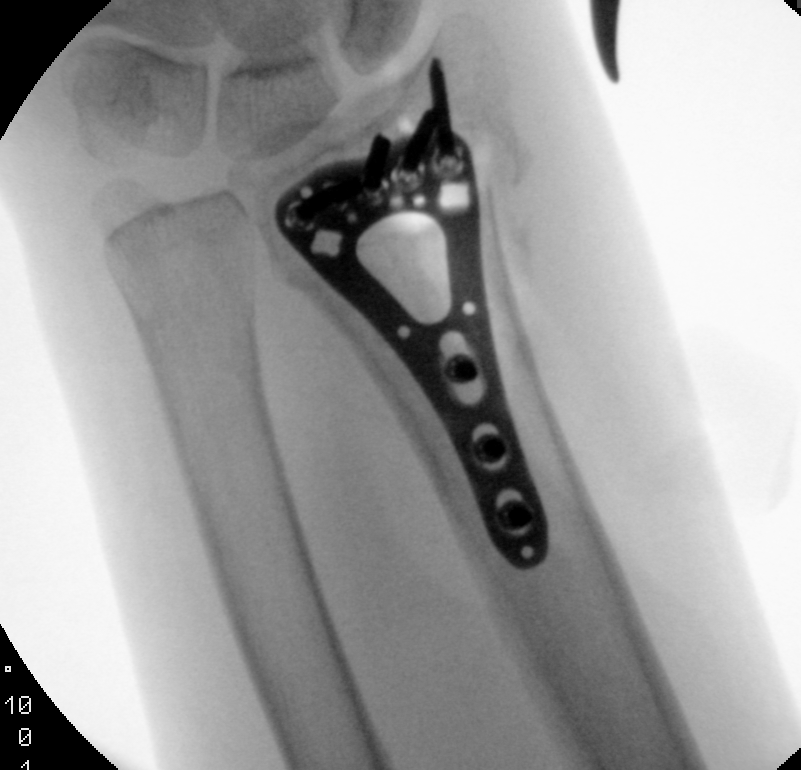 Fracture-Osteotomy distal radius