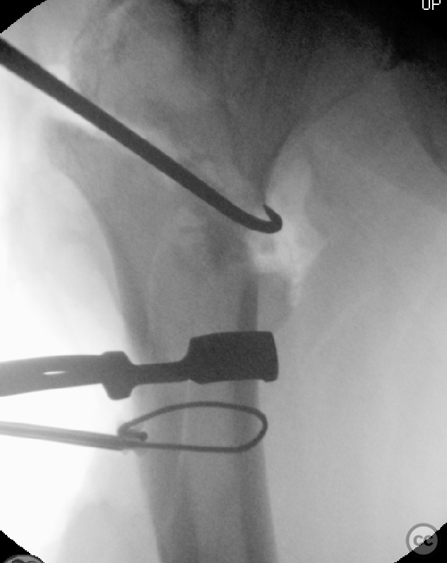 Hardware Failure of Primary Gamma Nail Osteosynthesis in ...