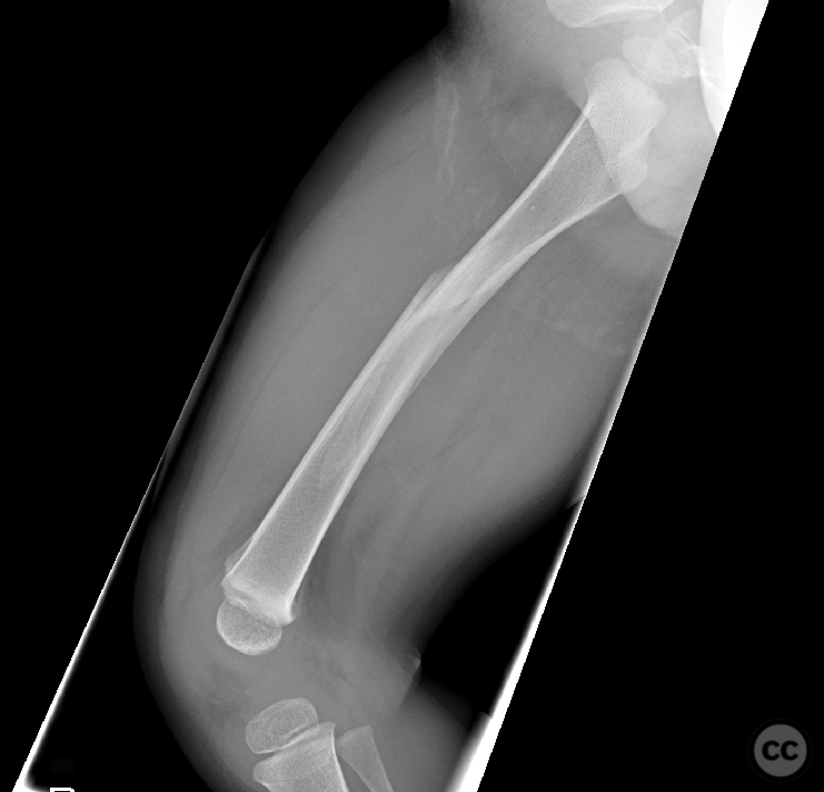 Femoral diaphyseal spiral fracture in 22 month old