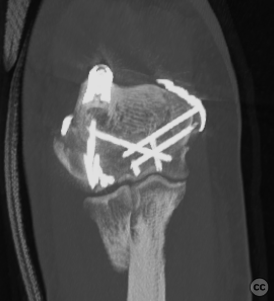 Dubberly 3/4 shear plus comminuted trans condylar trochlear fracture ...