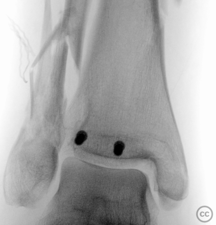 High-energy tibia and fibular fracture following a motorcycle accident