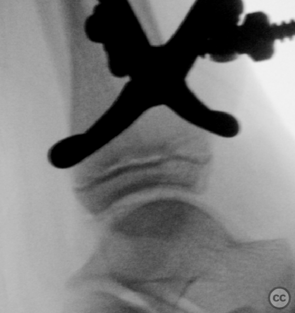 Percutaneous Cannulated Screw Fixation of a Triplanar Distal Tibial ...